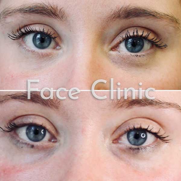 Face Clinic are experts at advanced dermal fillers