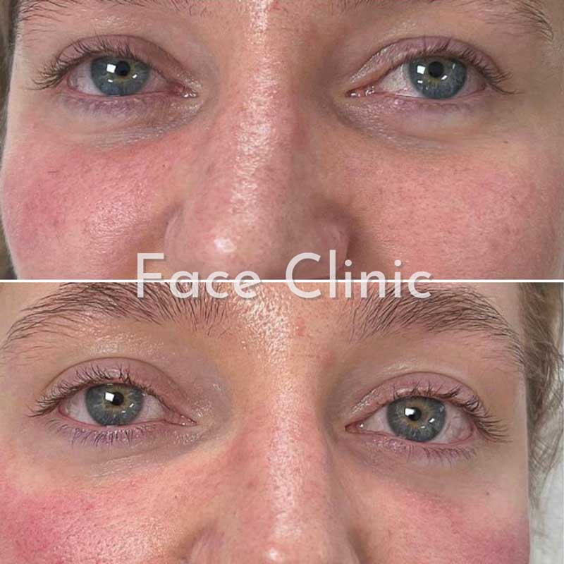 What is a Nucleofill treatment? – Dr. Georgiana Face Clinic